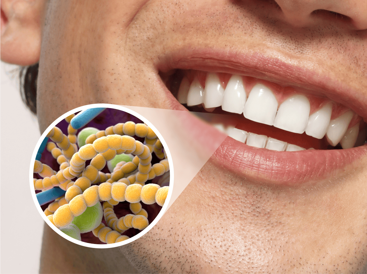 Caries Risk Analysis | Early detection & prevention of caries