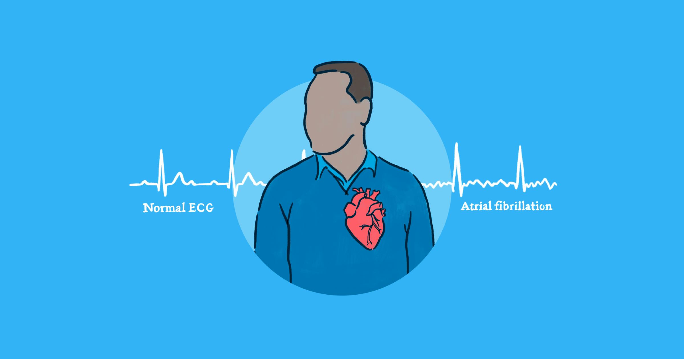 Atrial Fibrillation Explained Atrial Fibrillation Explained