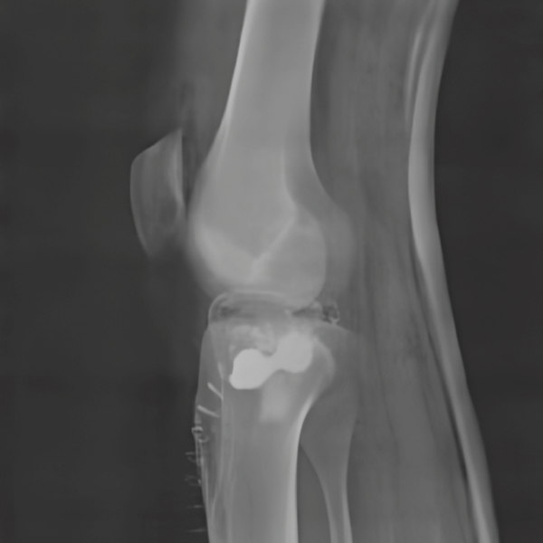 Neocement® Clinical Case 2