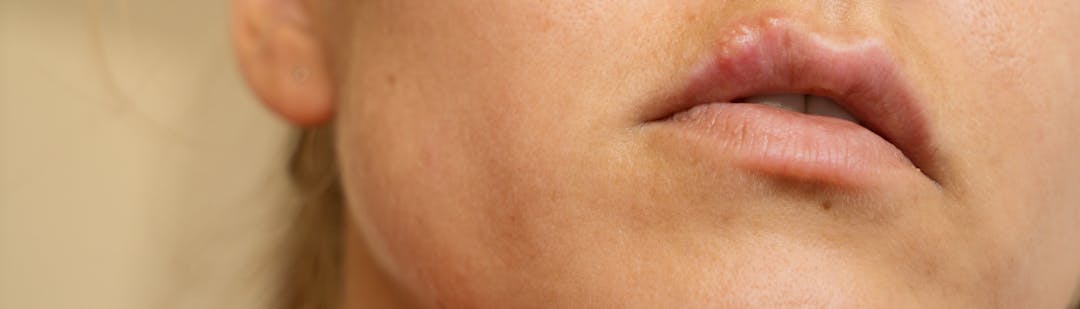 Comment traiter naturellement l'herpès labial ? | Boiron
