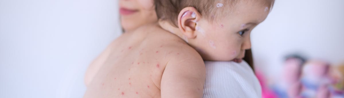 Calmer et soulager les démangeaisons de la varicelle chez l'enfant et ...