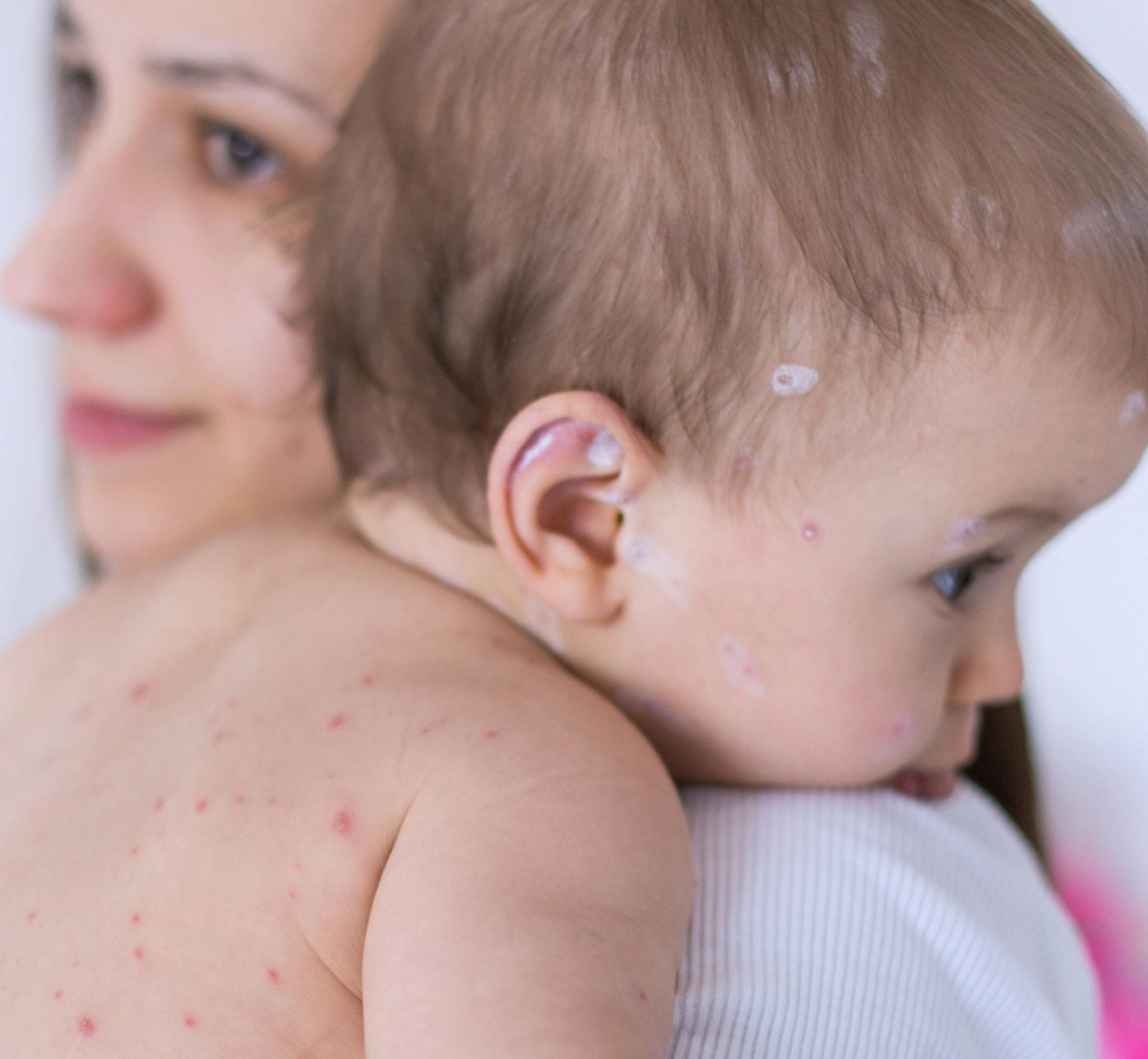 Calmer et soulager les démangeaisons de la varicelle chez l'enfant et ...