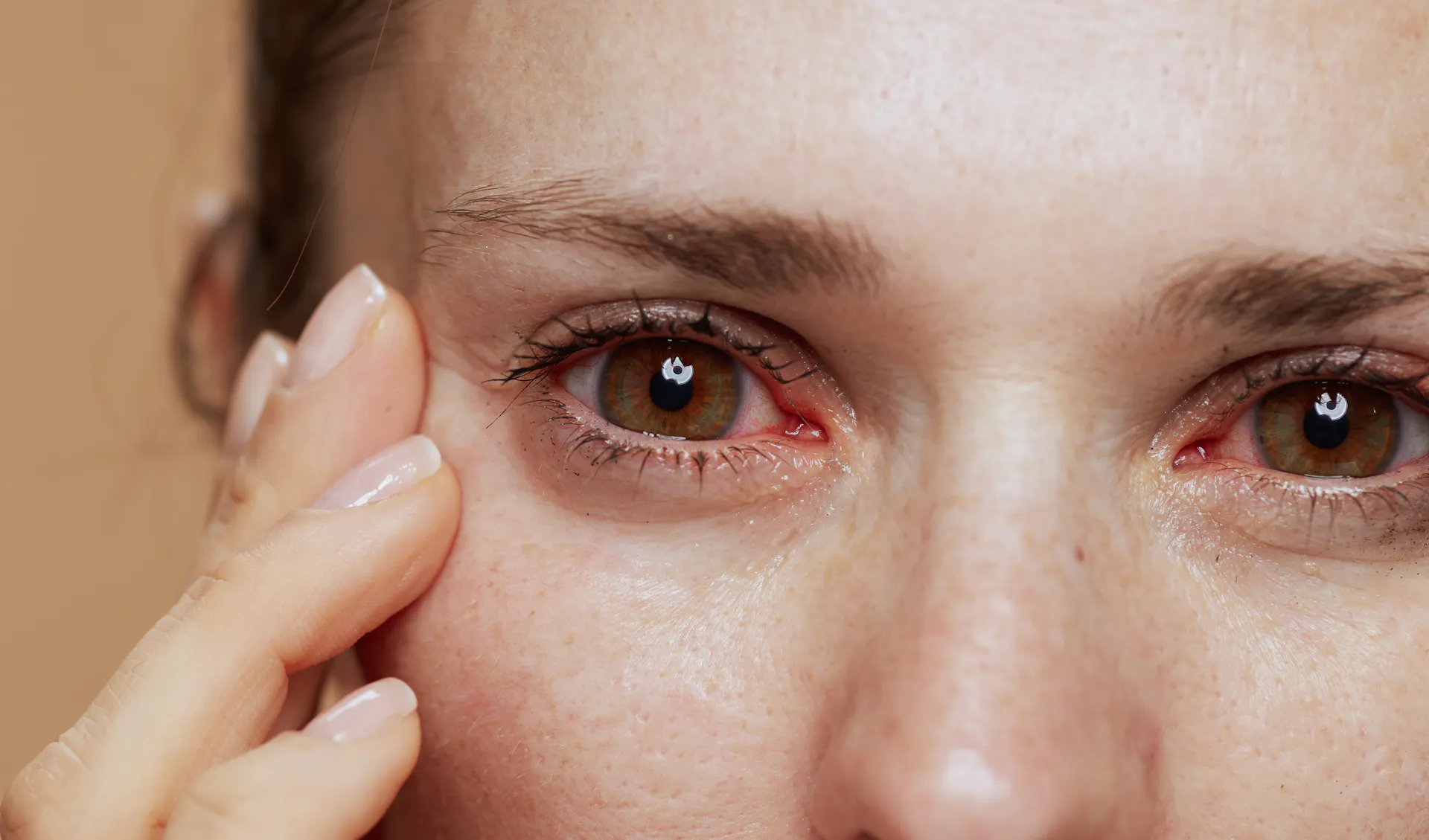 Síndrome del ojo seco: guía completa de prevención y alivio