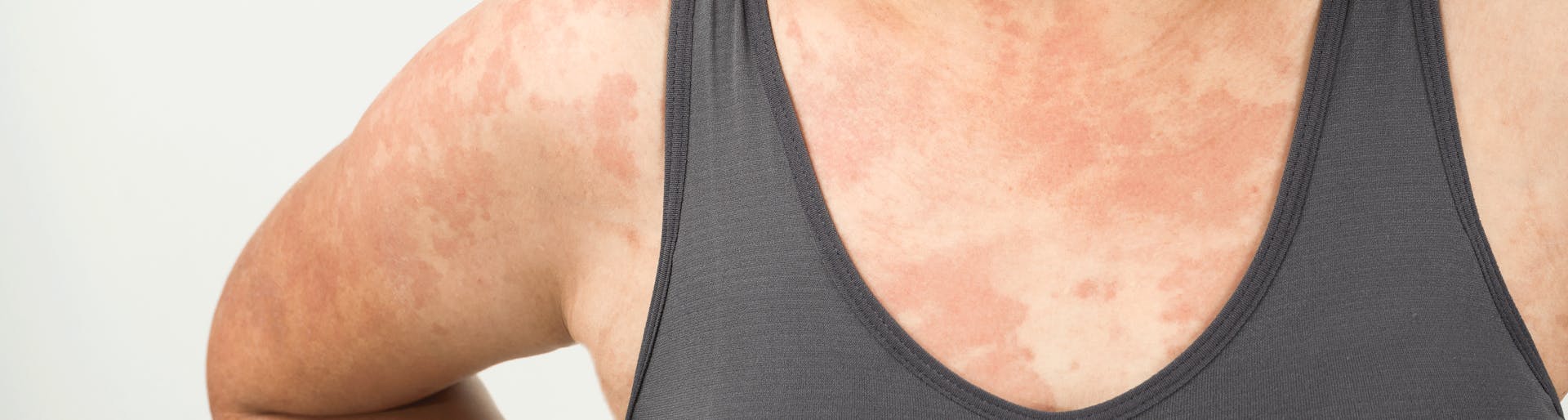 Comprendre l’urticaire : ses causes et les solutions thérapeutiques ...