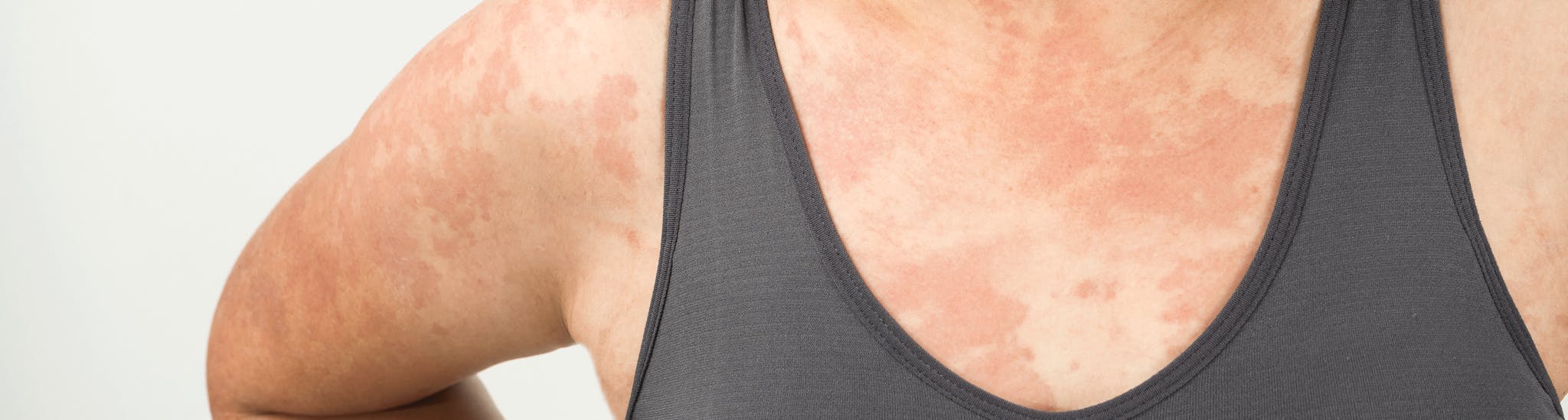 Comprendre l’urticaire : ses causes et les solutions thérapeutiques ...