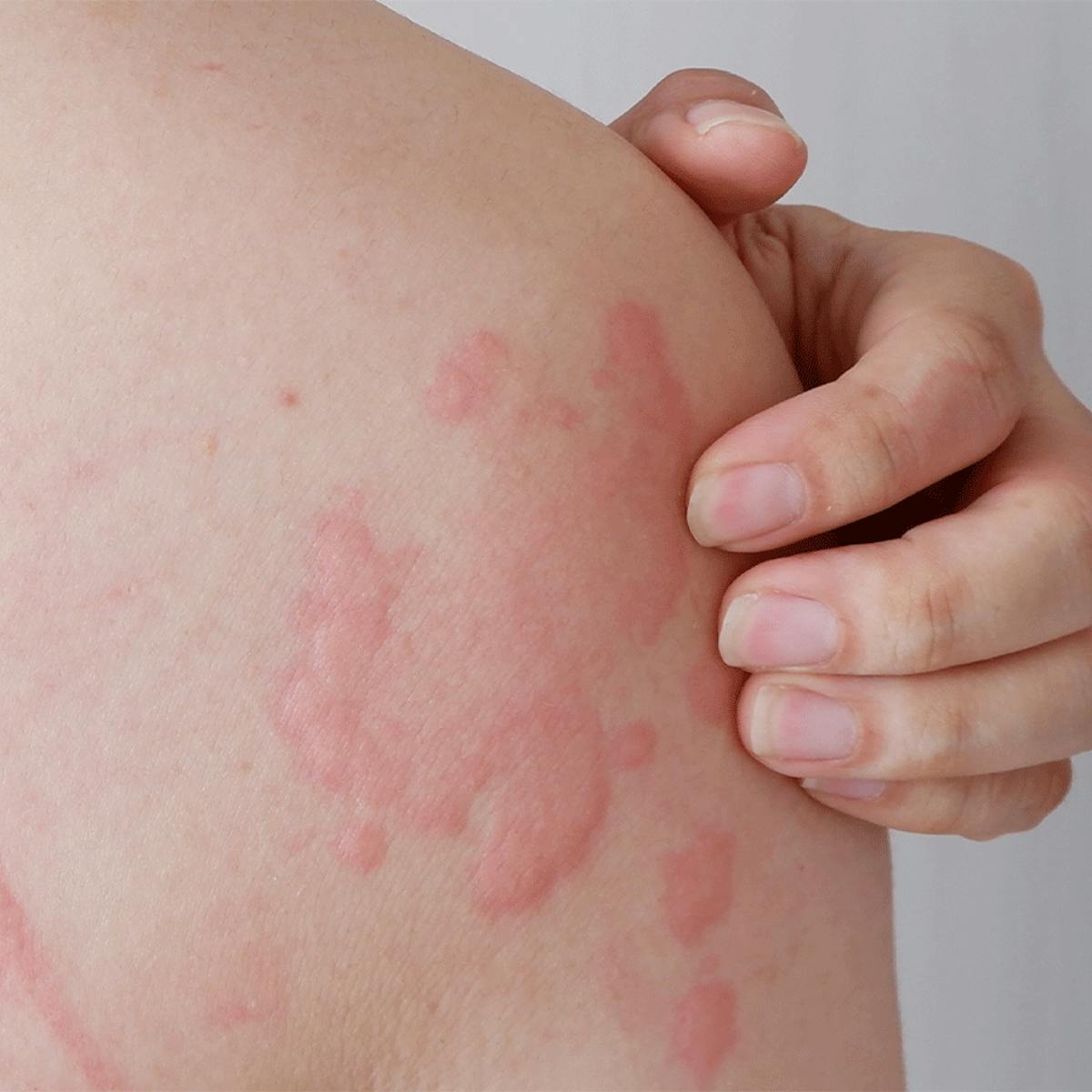 Comprendre l’urticaire : ses causes et les solutions thérapeutiques ...