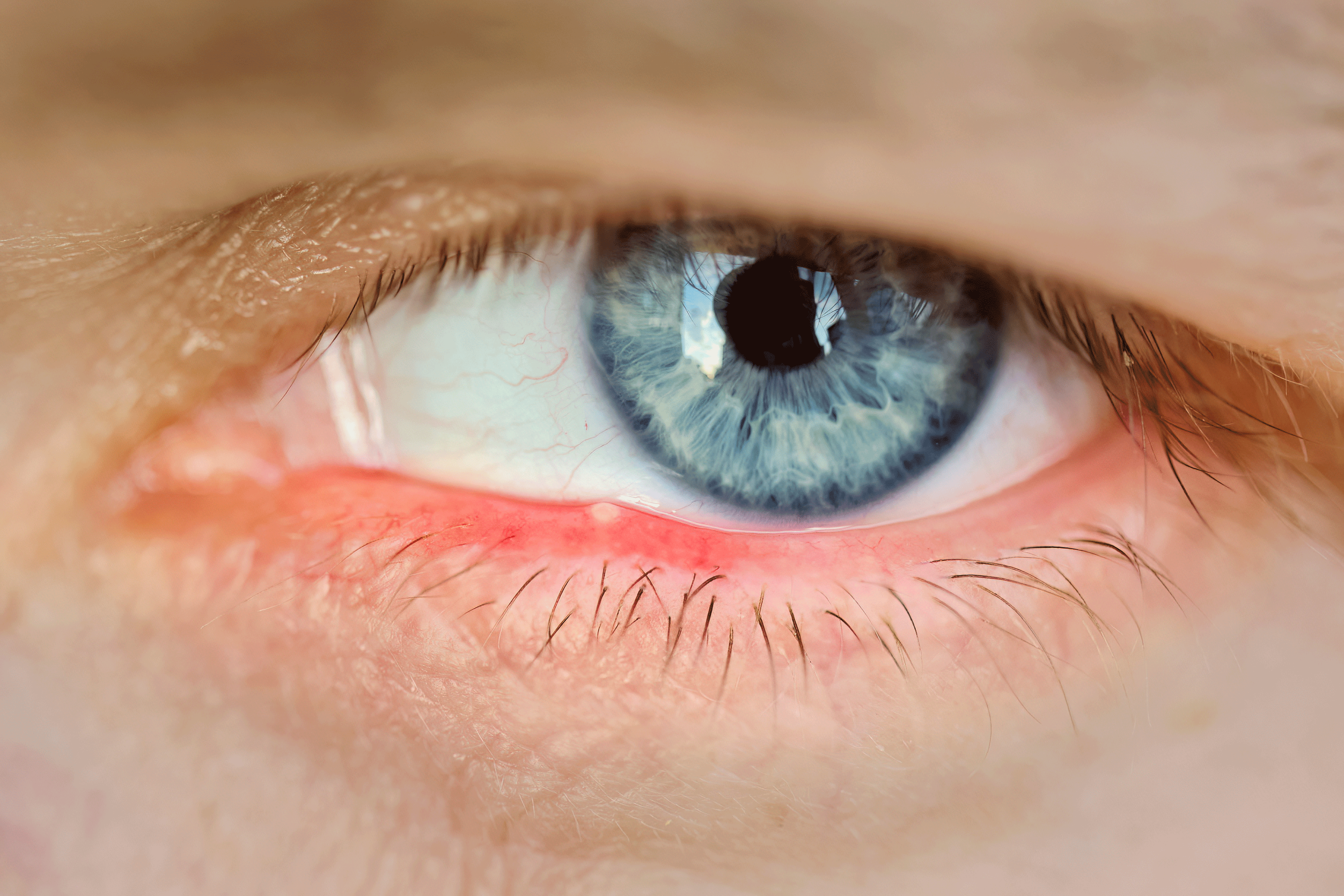 Quelles solutions naturelles pour réduire un orgelet ? | Les conseils ...