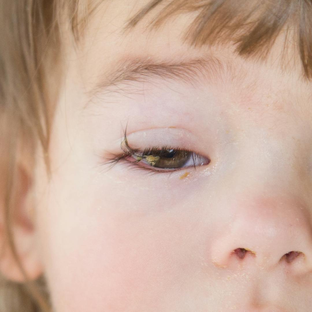 L'homéopathie pour soulager la conjonctivite | Boiron