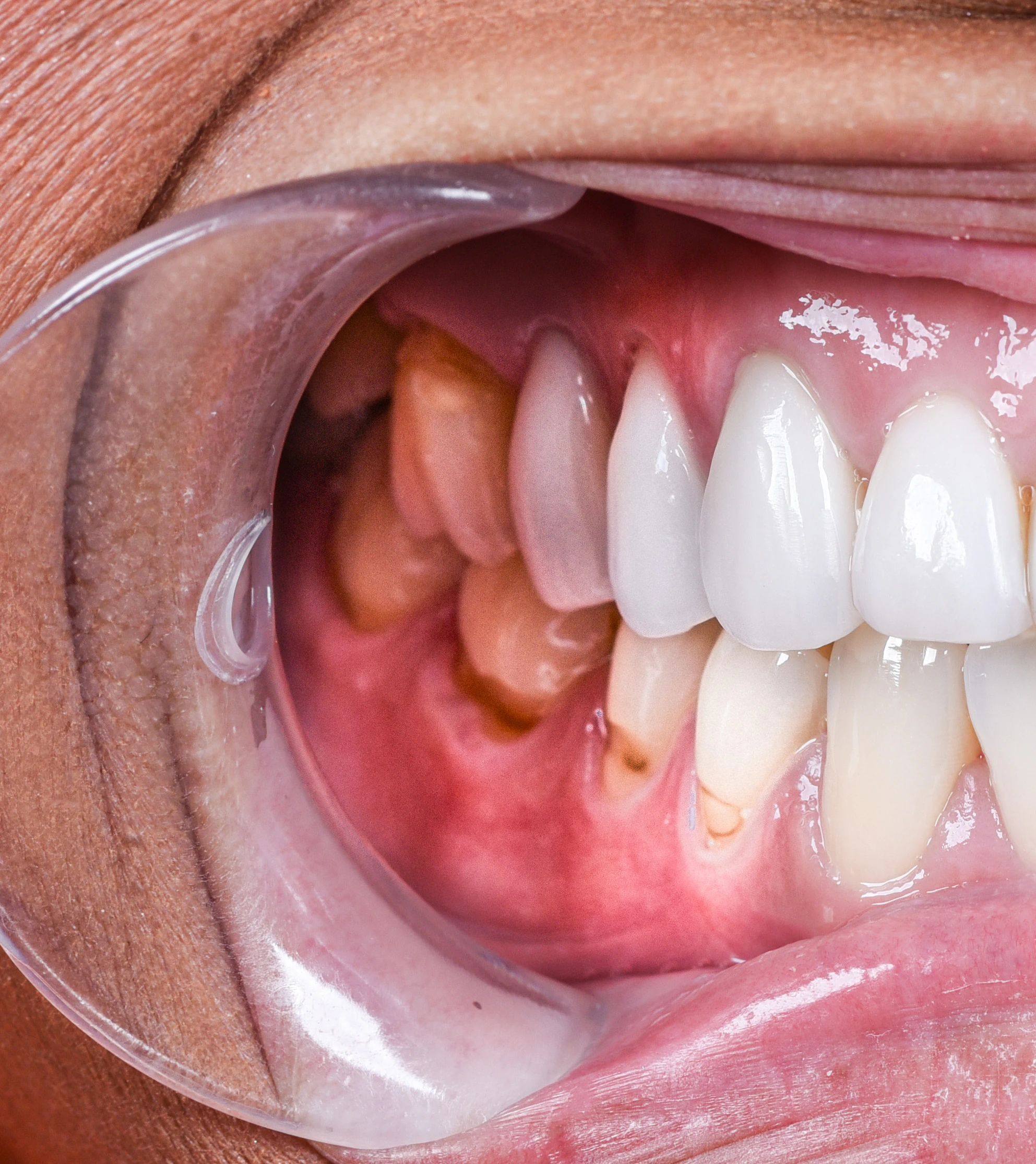 Abfraction Lesions & Bruxism: Causes, Signs & Treatment