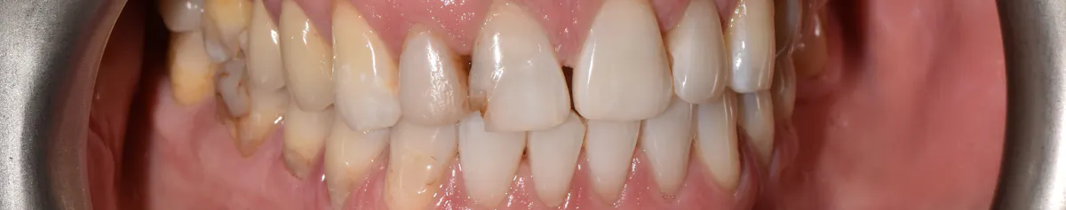 Abfraction Lesions & Bruxism: Causes, Signs & Treatment
