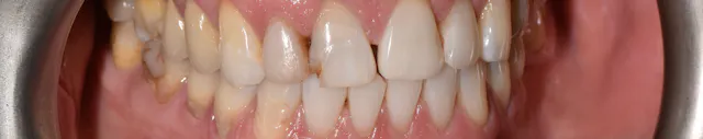 Abfraction Lesions & Bruxism: Causes, Signs & Treatment