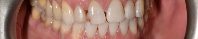 Abfraction Lesions & Bruxism: Causes, Signs & Treatment
