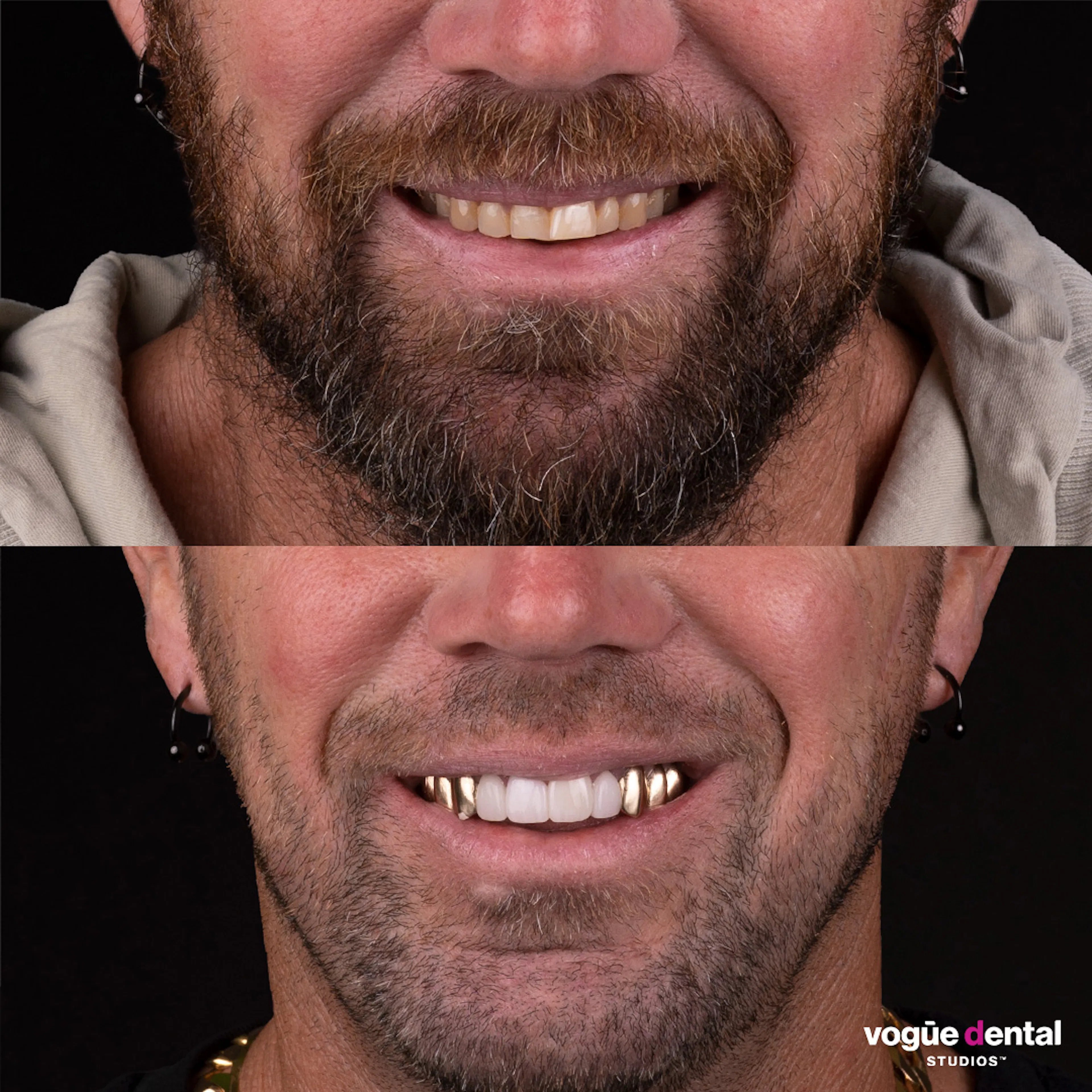 The Rise Of Gold Veneers And Crowns