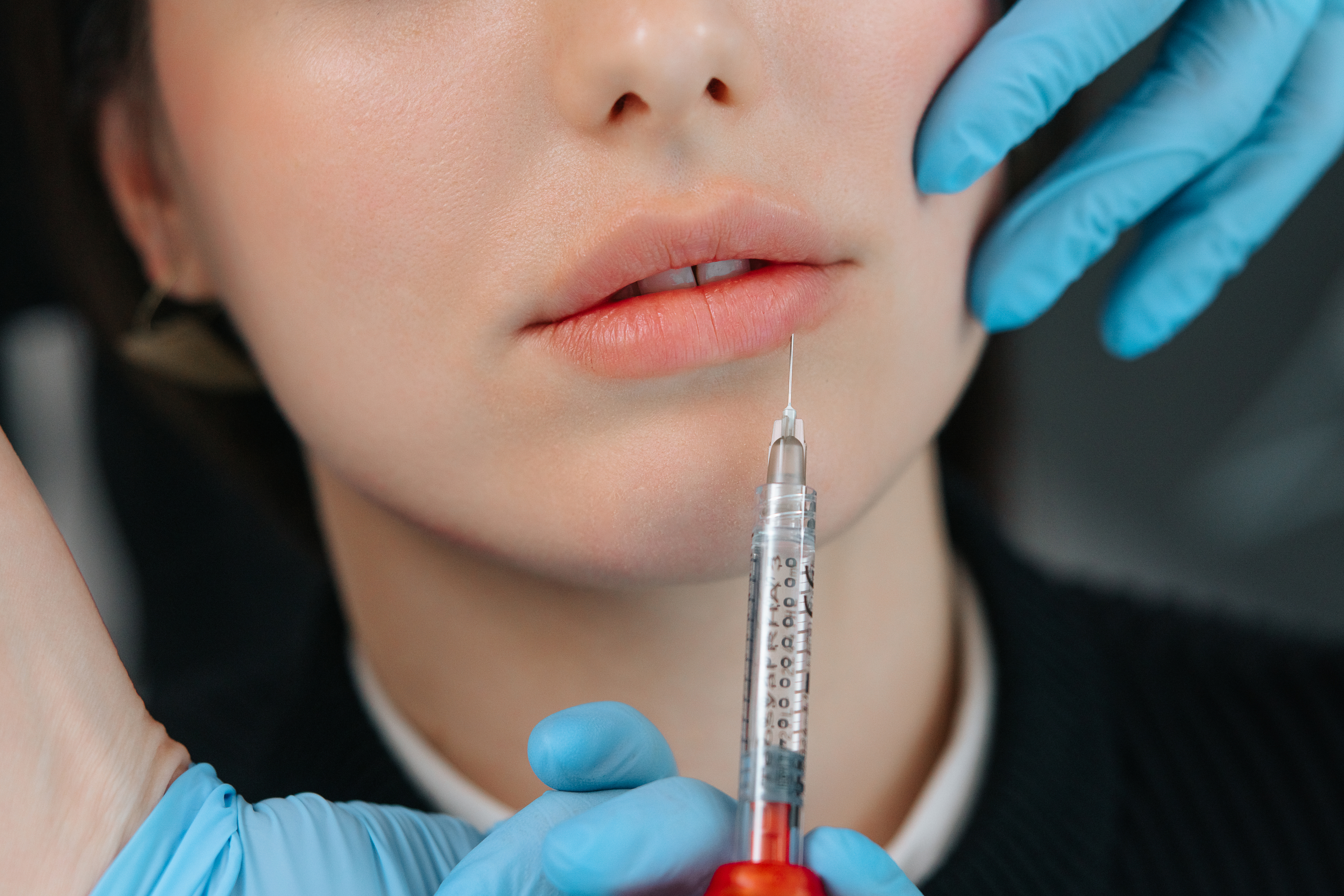 Zašto su lip-fileri jedna od najtraženijih estetskih usluga?