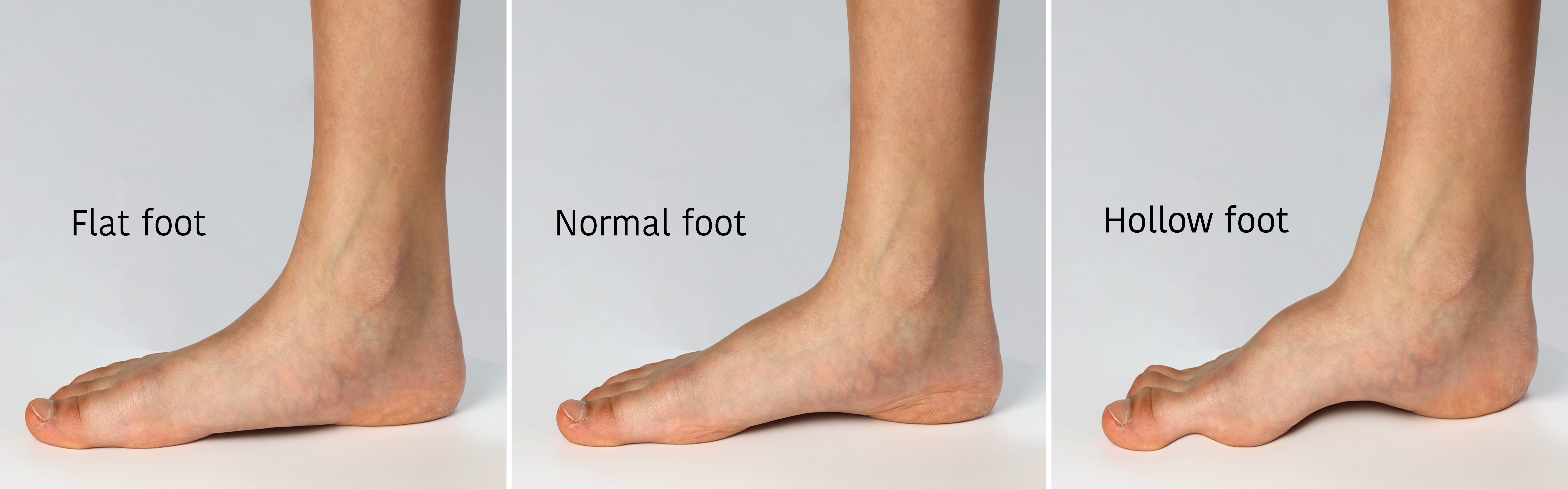 Flat Feet | Treatments, Symptoms, and Causes | CLS Health