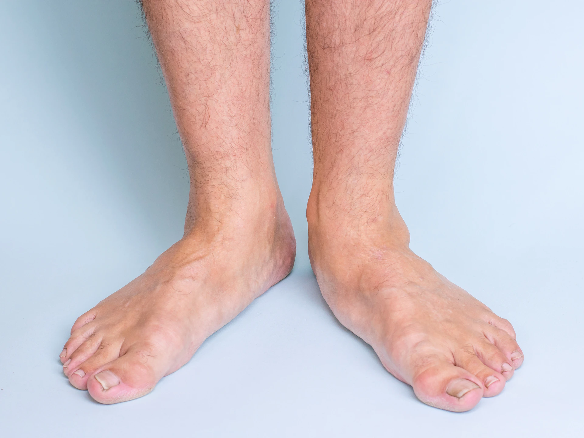 Flat Feet Symptoms: How to Tell If You Have Flat Feet | CLS Health
