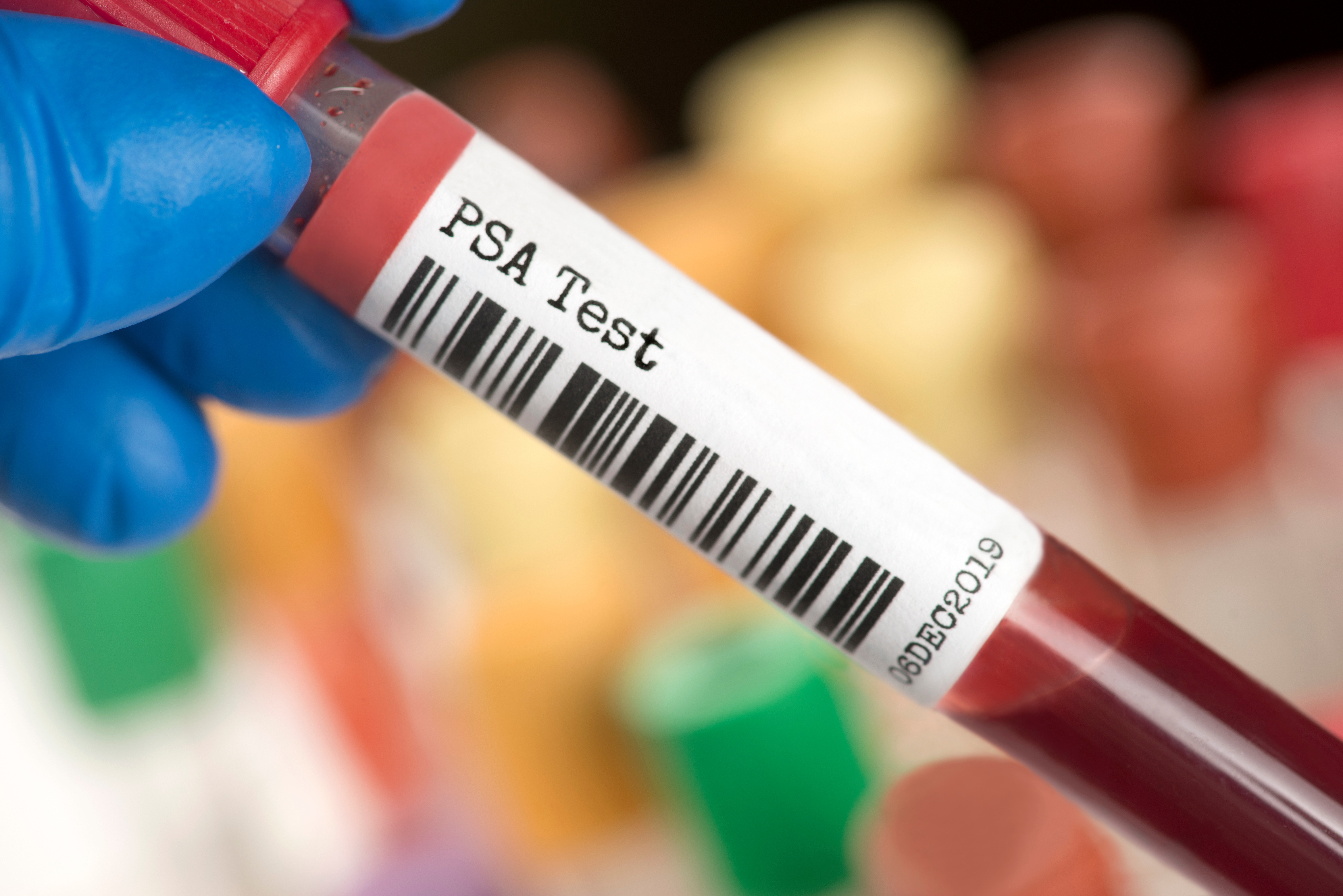 Elevated PSA Levels: Causes, Symptoms & Next Steps | CLS Health