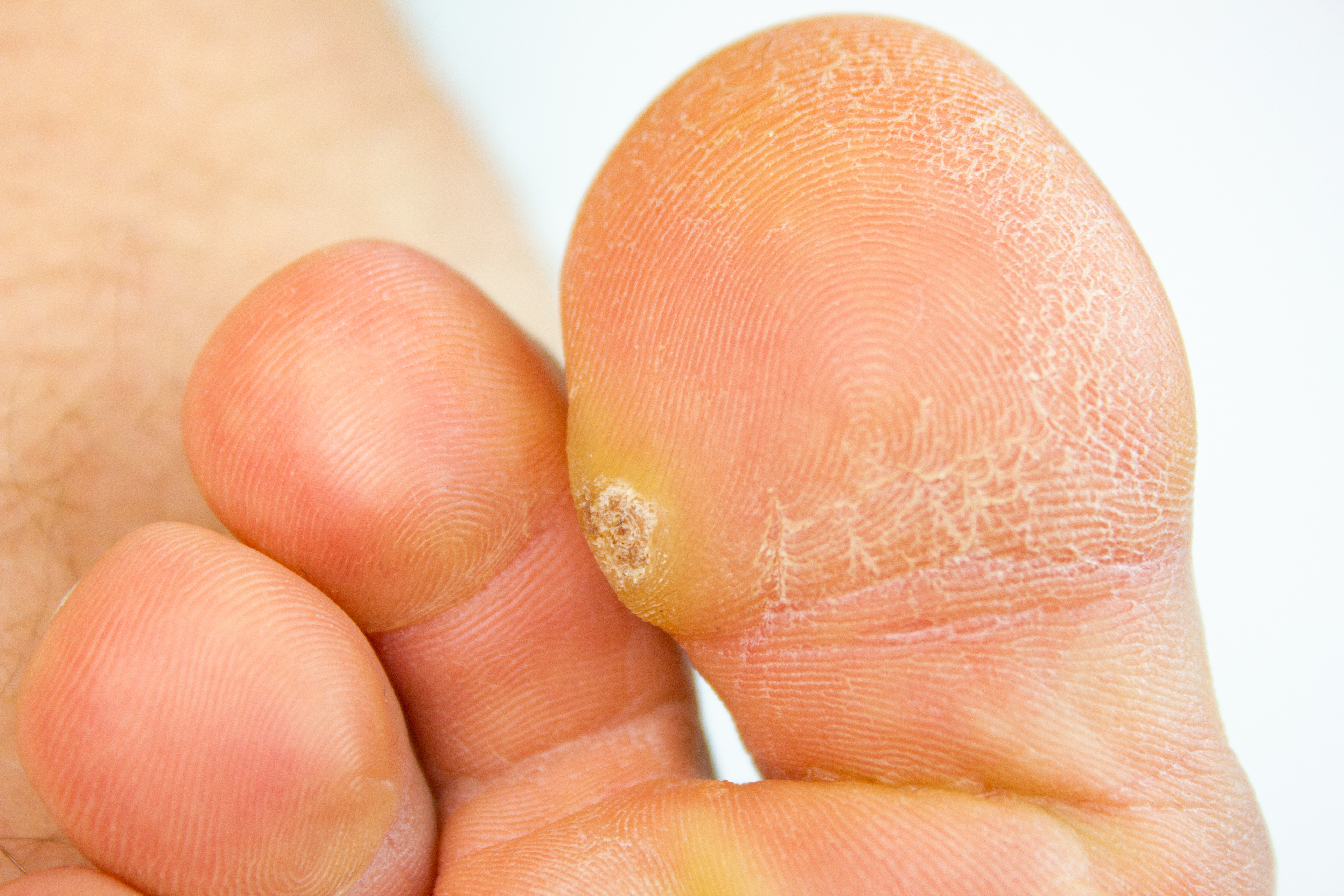 Plantar Wart Removal in Houston | Foot Wart Treatment | CLS Health ...