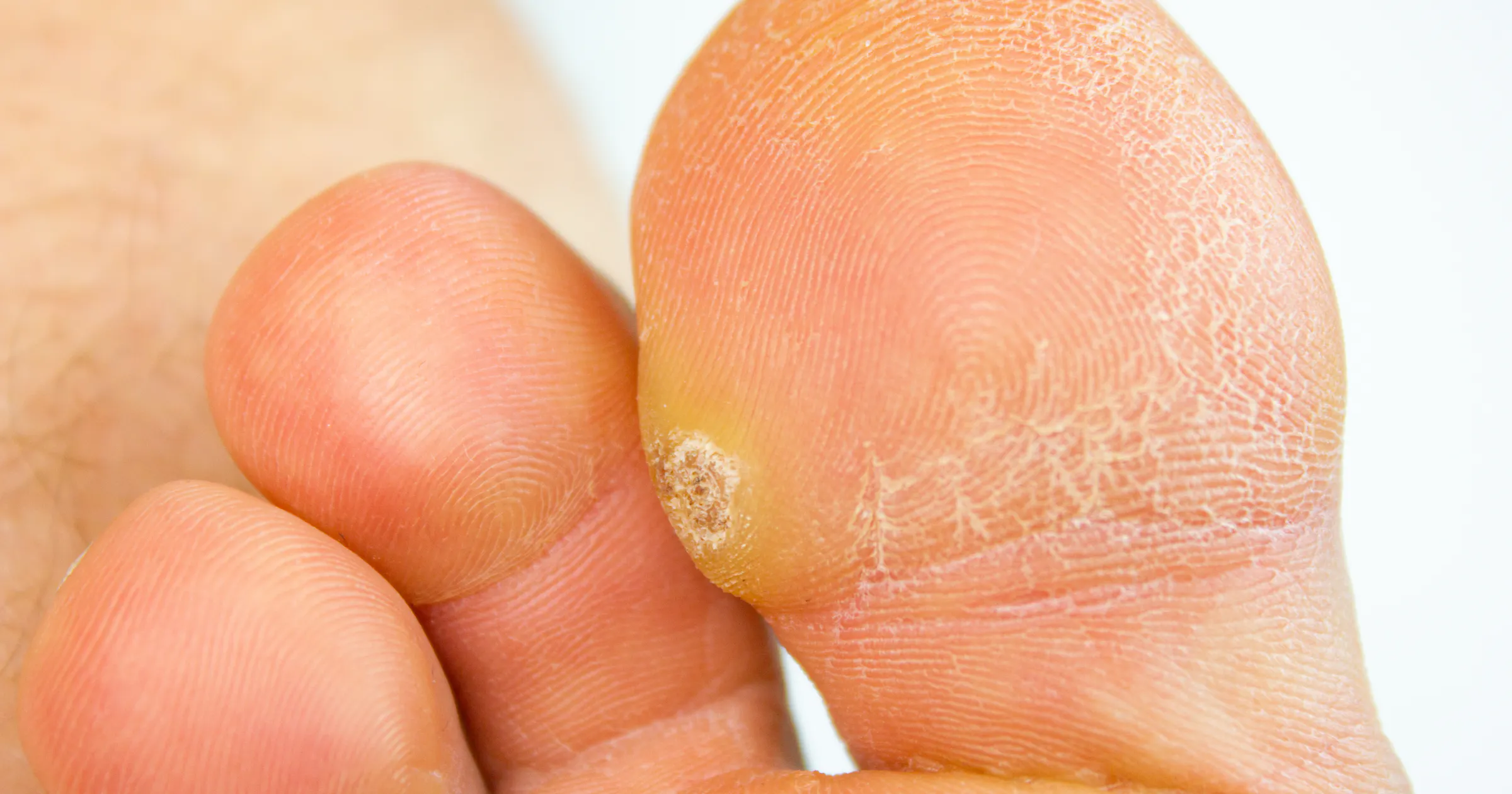 Plantar Wart Removal In Houston Foot Wart Treatment CLS Health Plantar Wart Removal In Houston Foot Wart Treatment CLS Health