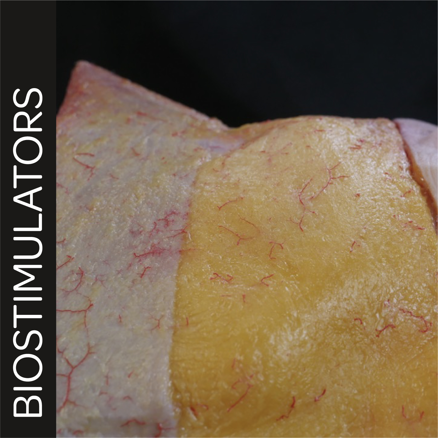 Biostimulator Treatments: Tightening the Lateral Face