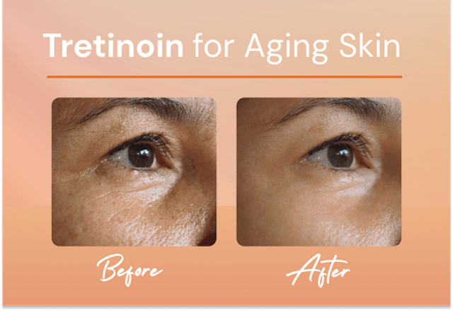 Hyperpigmentation and Sunscreen: What You Need To Know