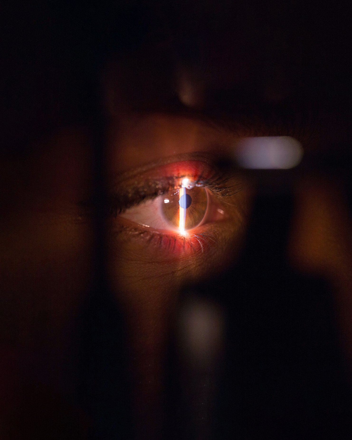 Laser Treatment — Mr John Awad