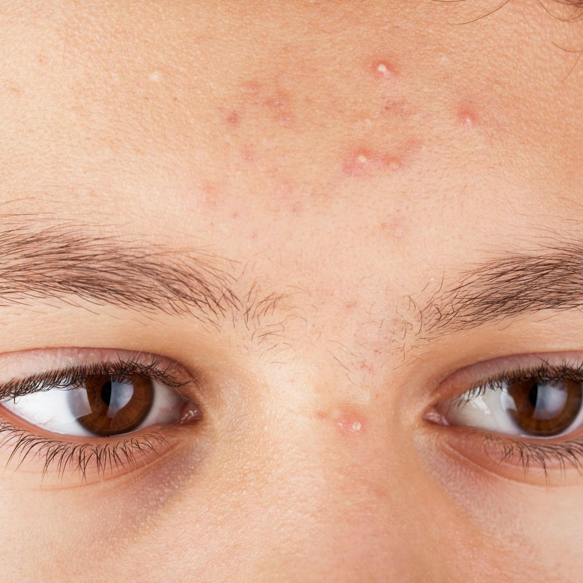Types of pimples: All You Need to Know About Acne | Fluent Health