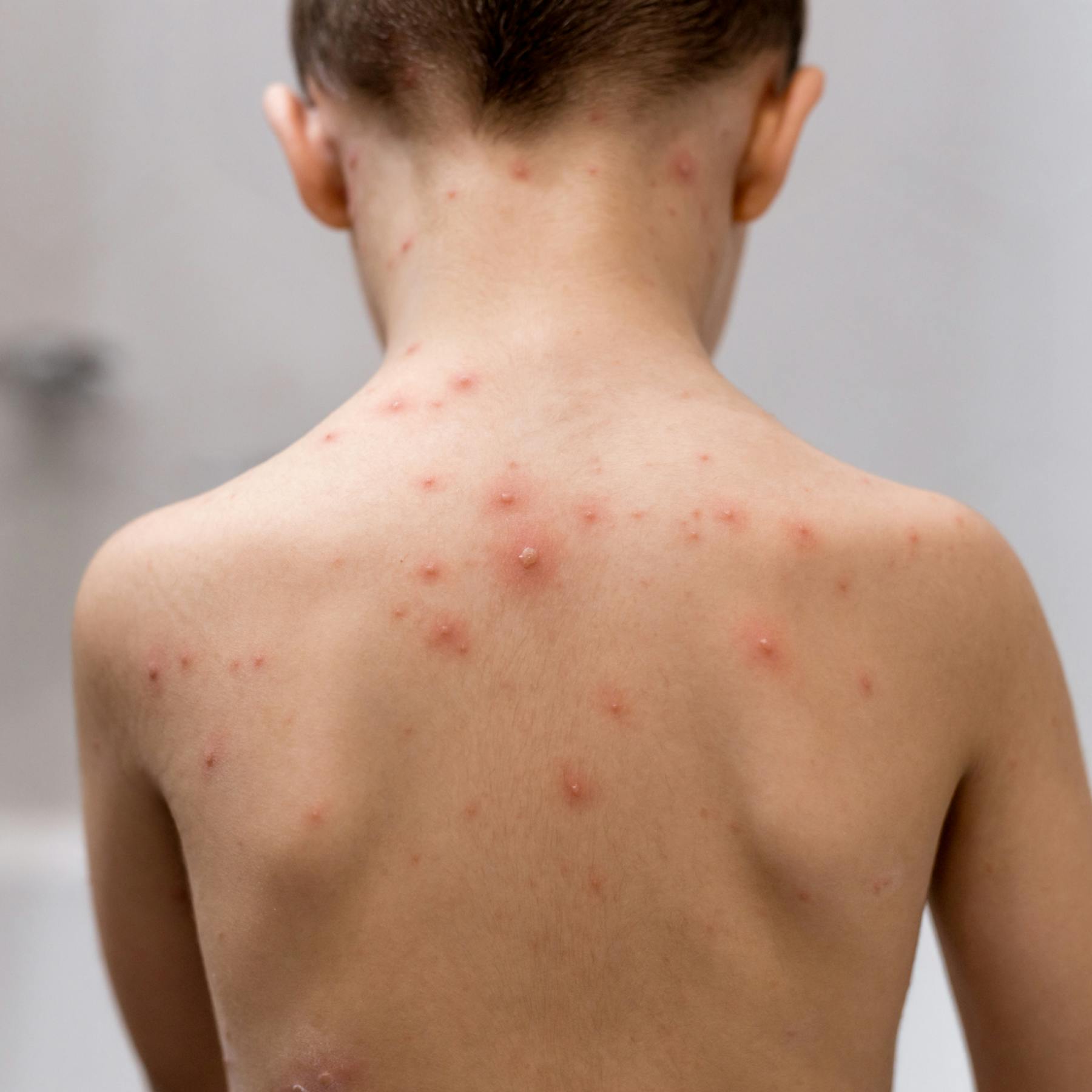 Itchy Rash & A Fever? Learn All About Chickenpox | Fluent Health