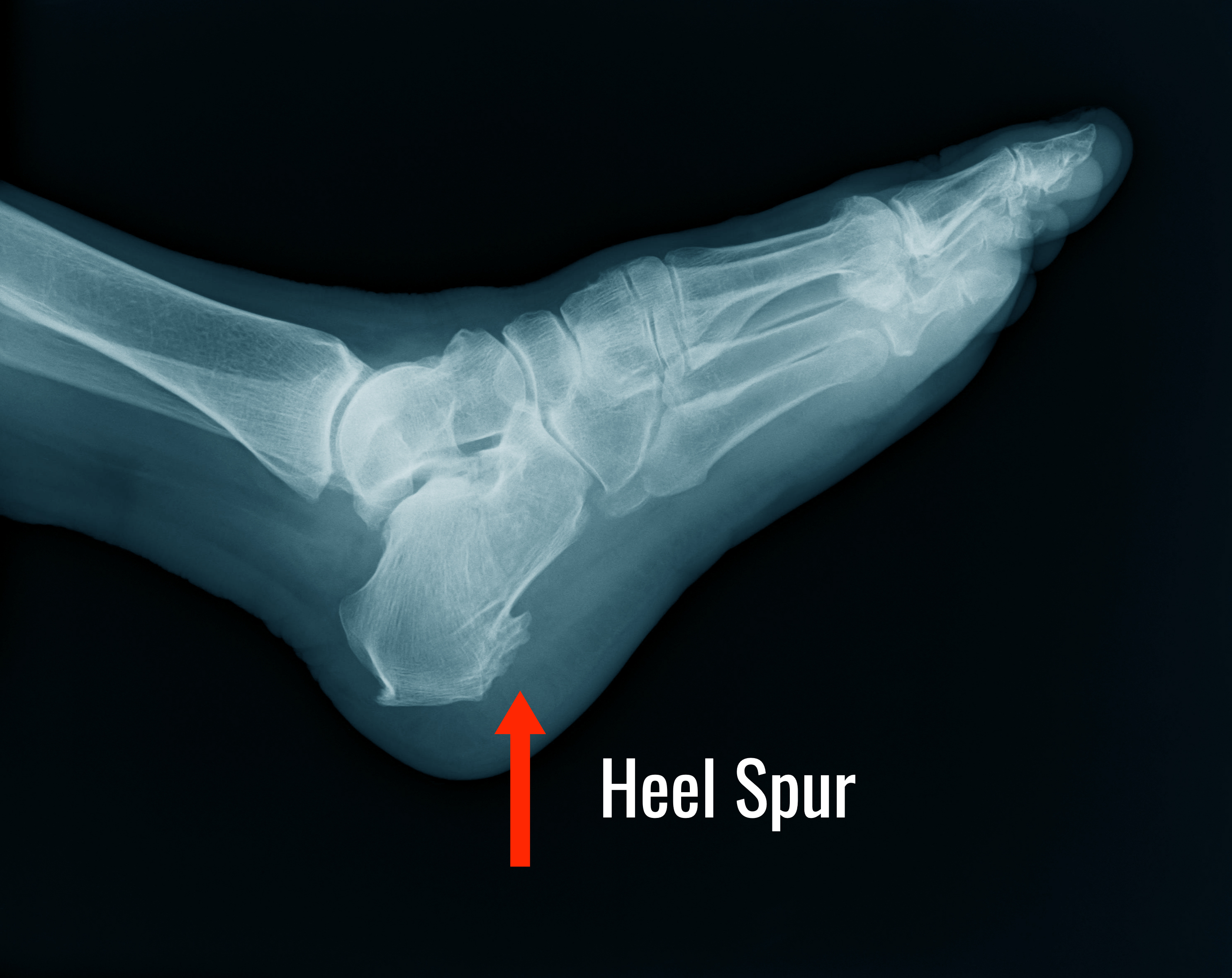 Posterior Calcaneal Spur X Ray