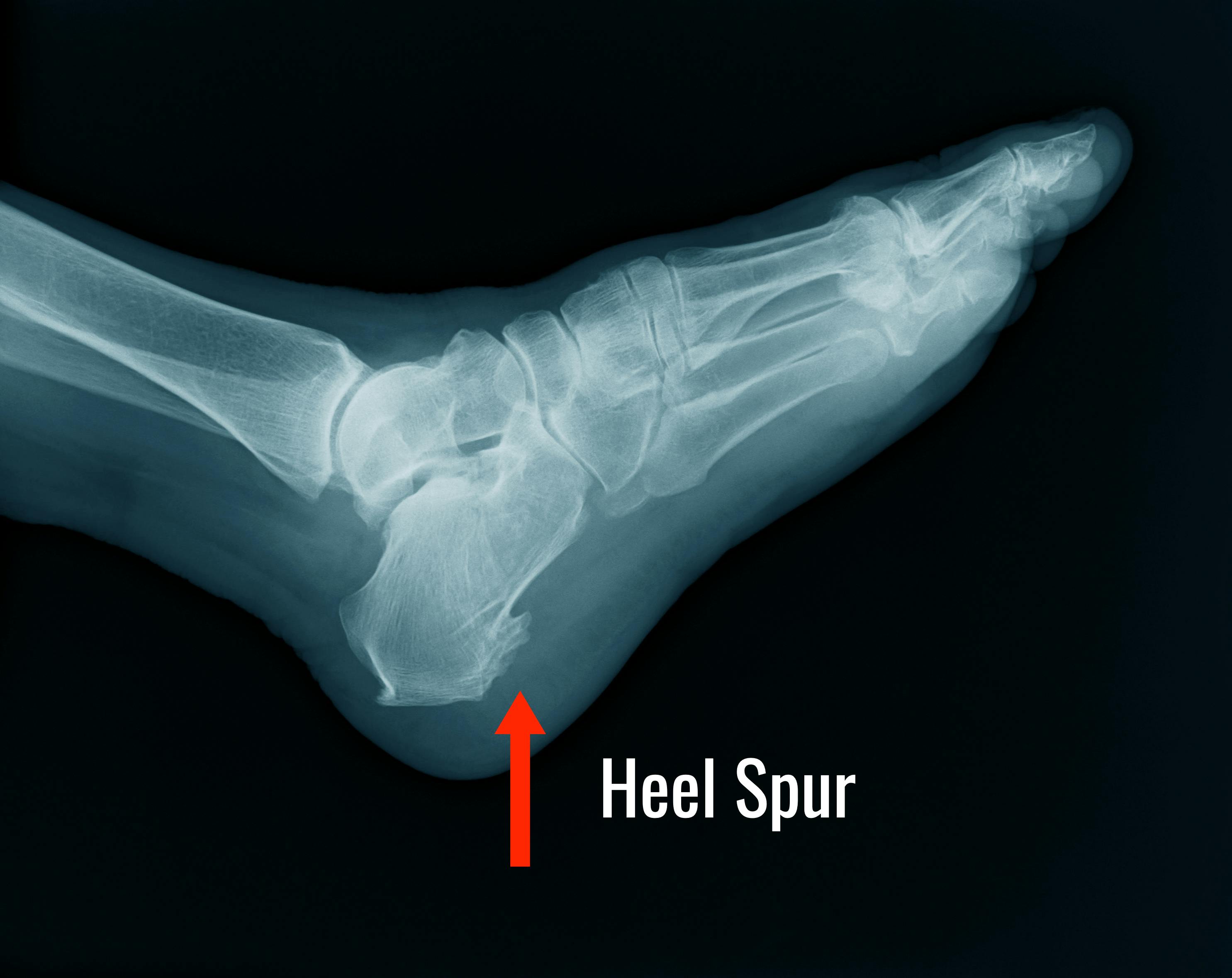 Heel Spur X Ray