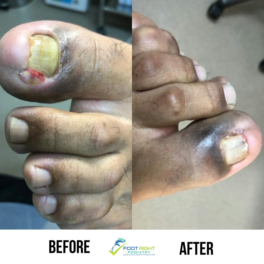 Nail Surgery - Before and After | Foot Right Podiatry