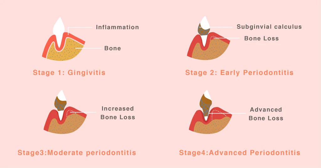 Periodontal Disease Stages In Dogs