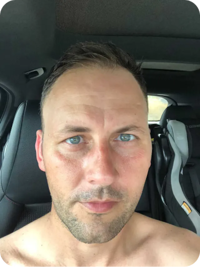 Hair Loss Treatment for Men | Mosh