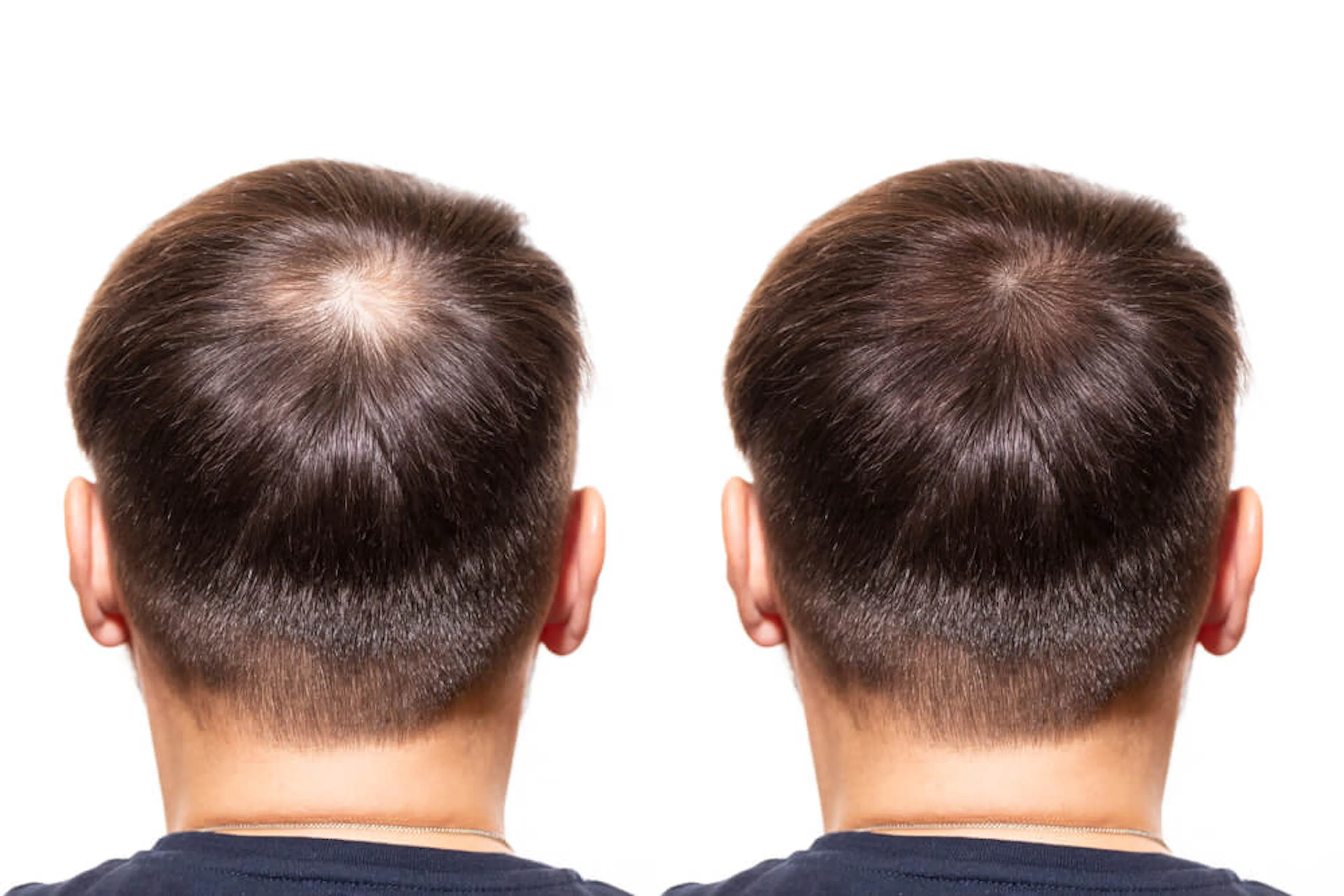 Minoxidil Hair Loss Treatment | Mosh