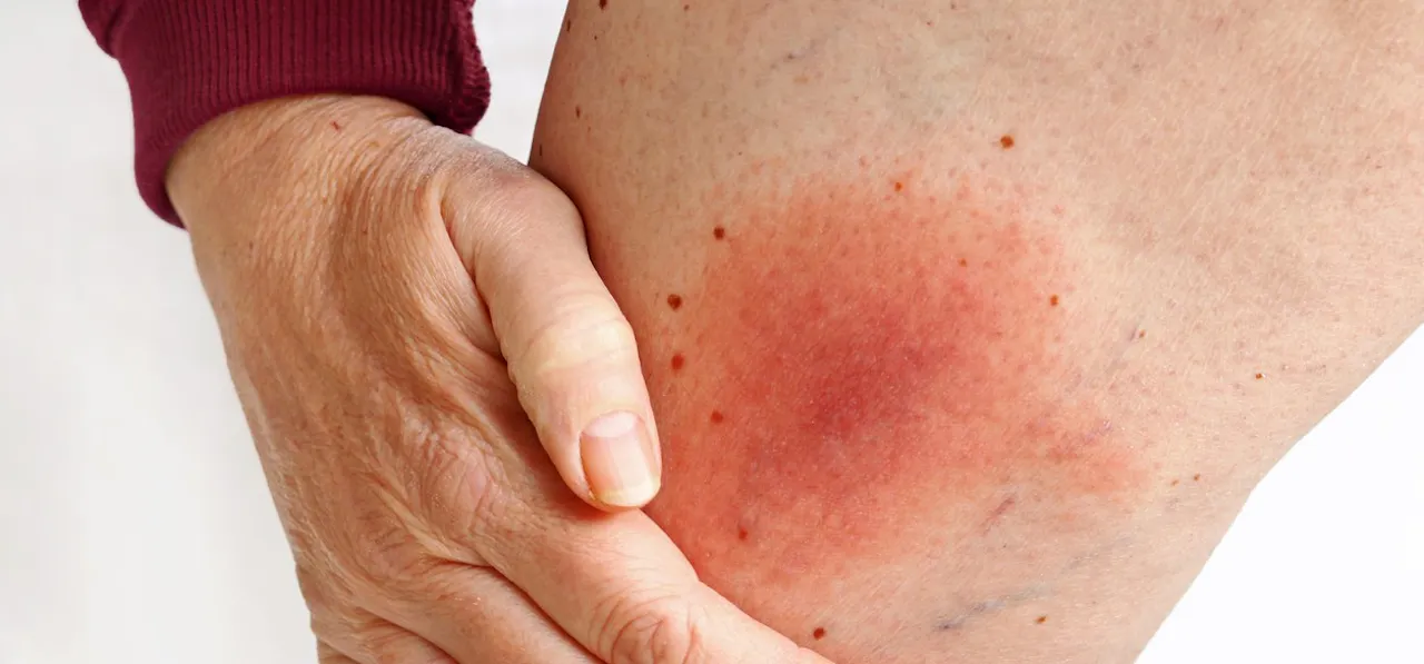 Five Fast Facts About Cellulitis Skin Infections GoHealth Urgent Care Five Fast Facts About Cellulitis Skin Infections GoHealth Urgent Care