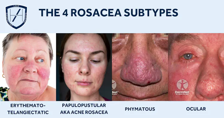 How to Identify and Treat Rosacea as an Aesthetic Practitioner
