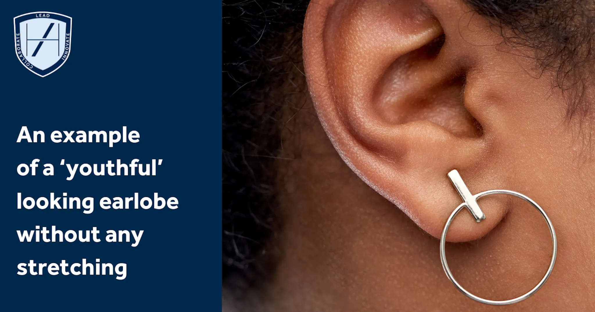 What is Earlobe Filler and Should I Offer This Aesthetic Treatment ...