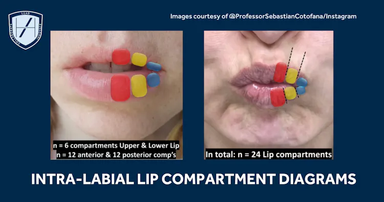 Understanding Lip Anatomy to Reduce Lip Filler Migration Risks