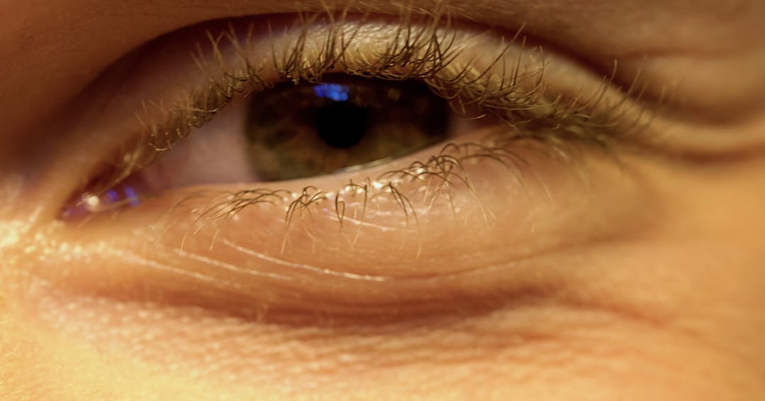 What is Jelly Roll Botox? A Guide for Aesthetic Practitioners