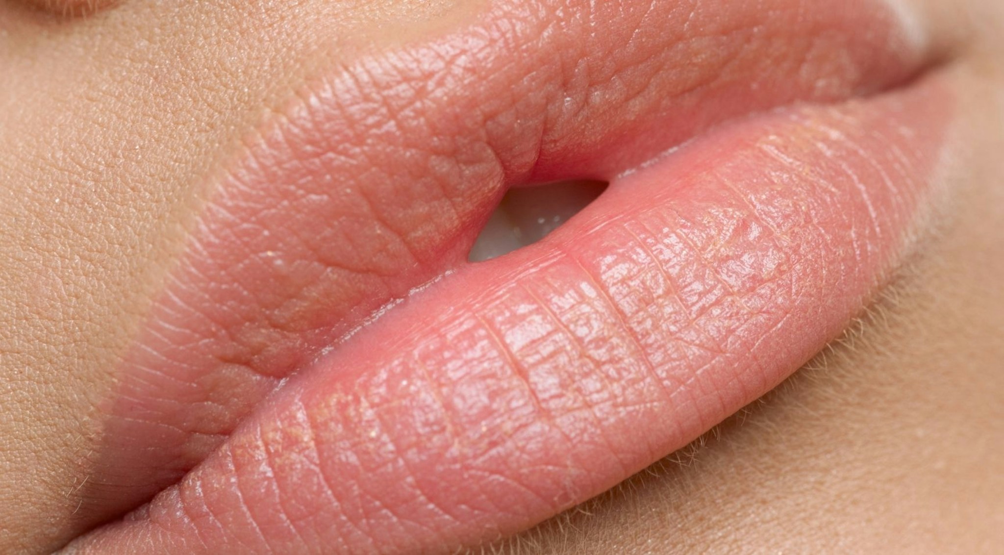 What is the Keyhole Lip Filler Technique?