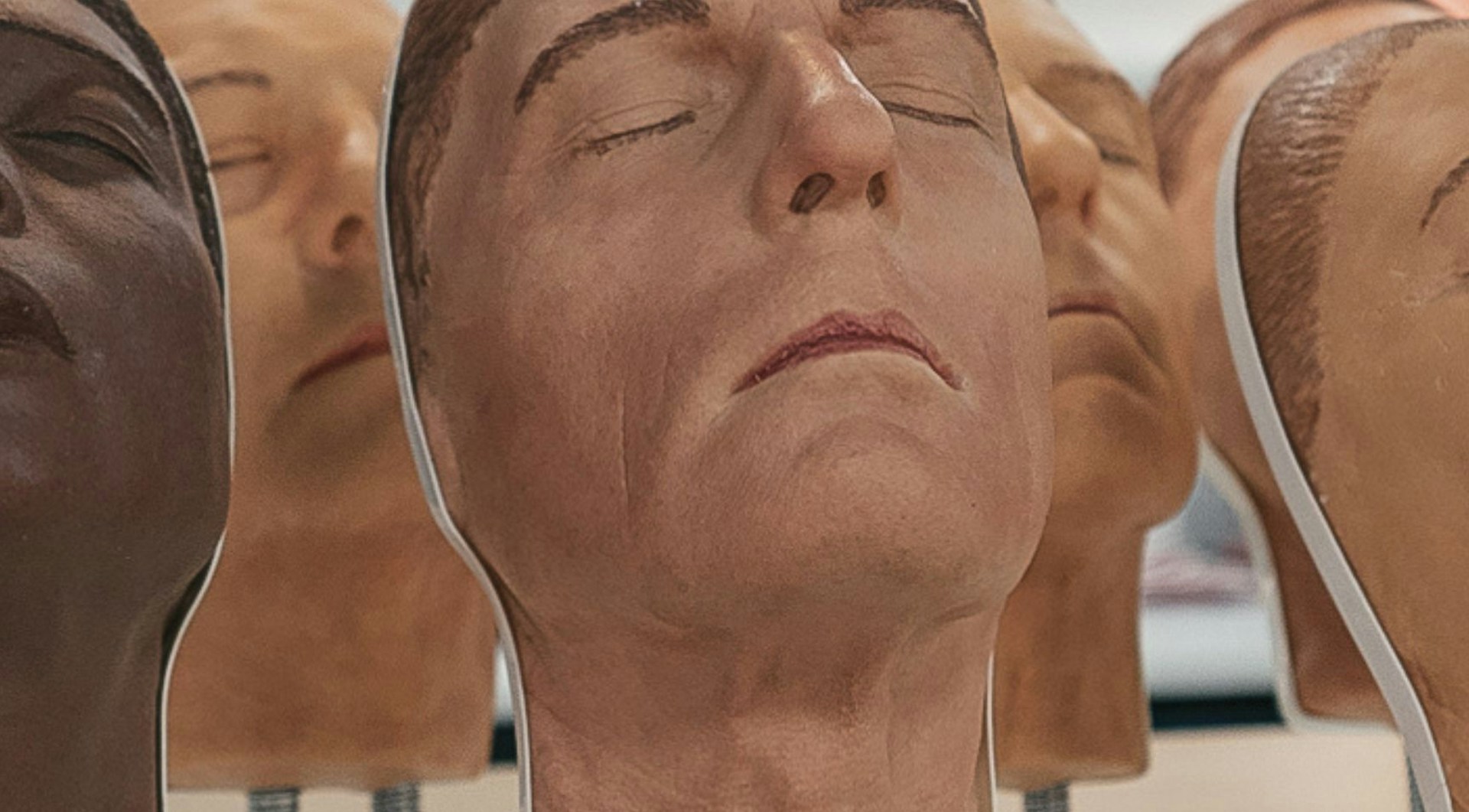 How to Treat Marionette Lines: Filler Injection Techniques