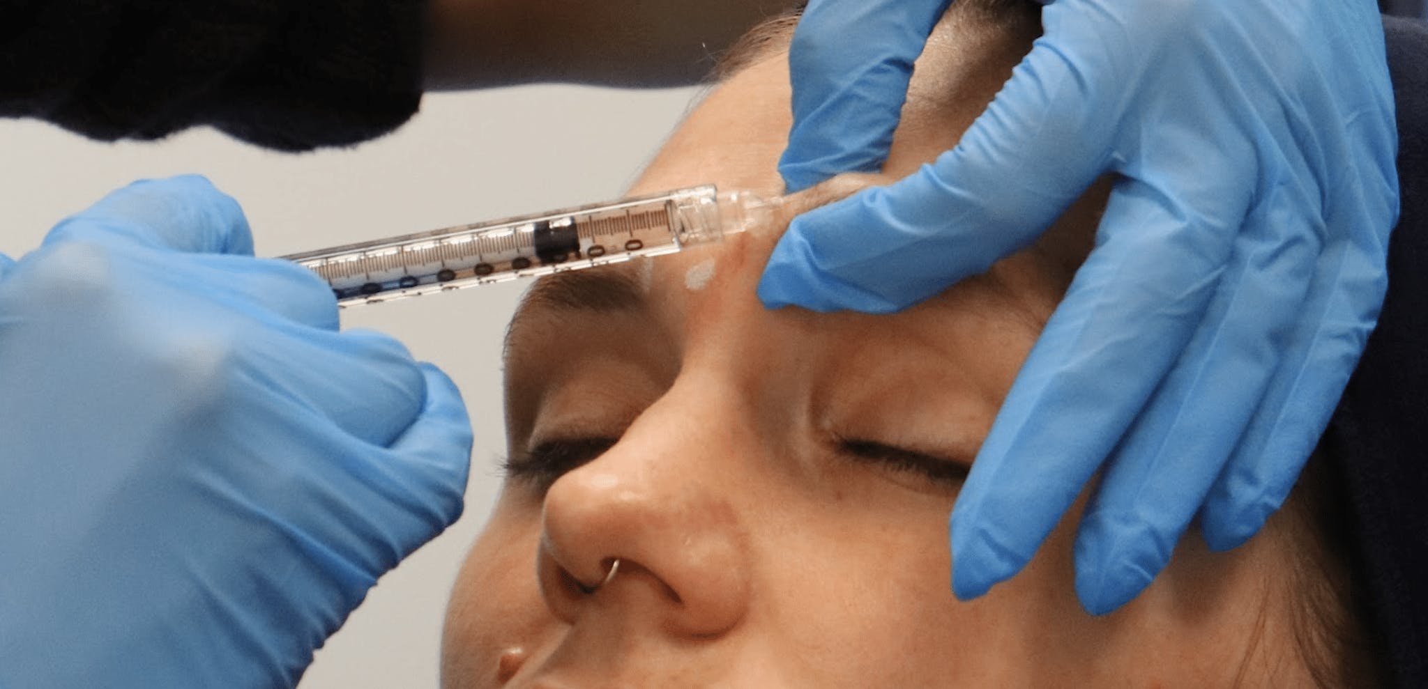 What causes Botox Diffusion and how to manage it