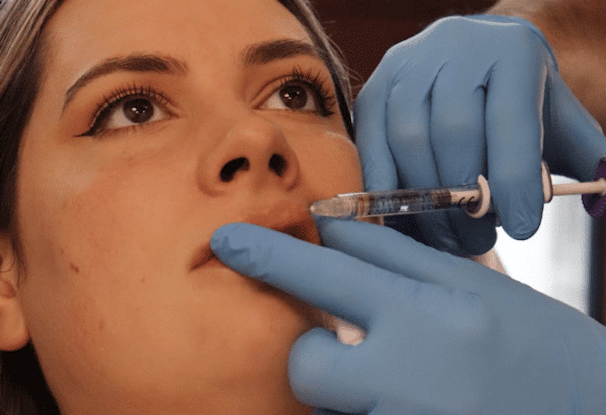 4 Essential Dermal Filler injecting techniques