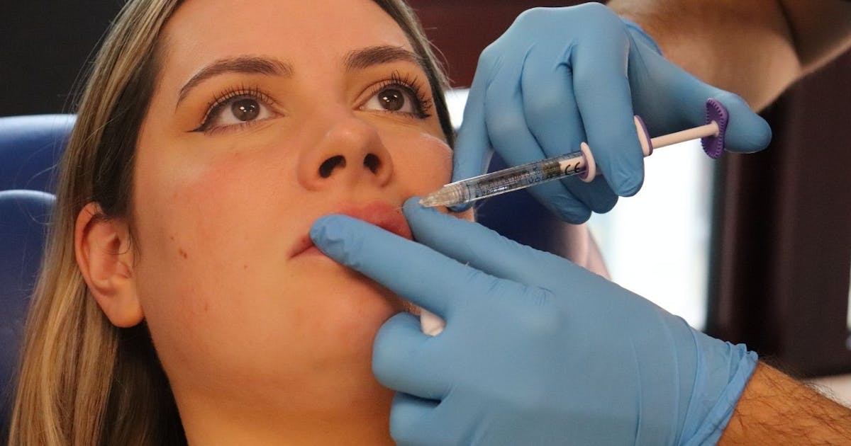 What is the Keyhole Lip Filler Technique?