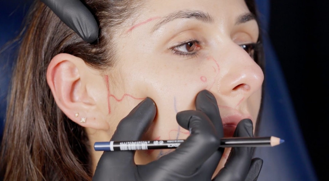 Key Mid-Face Filler Treatments for Rejuvenation | Harley Academy