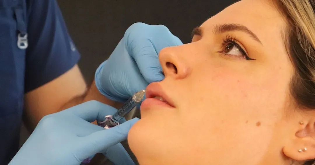What is the Keyhole Lip Filler Technique?