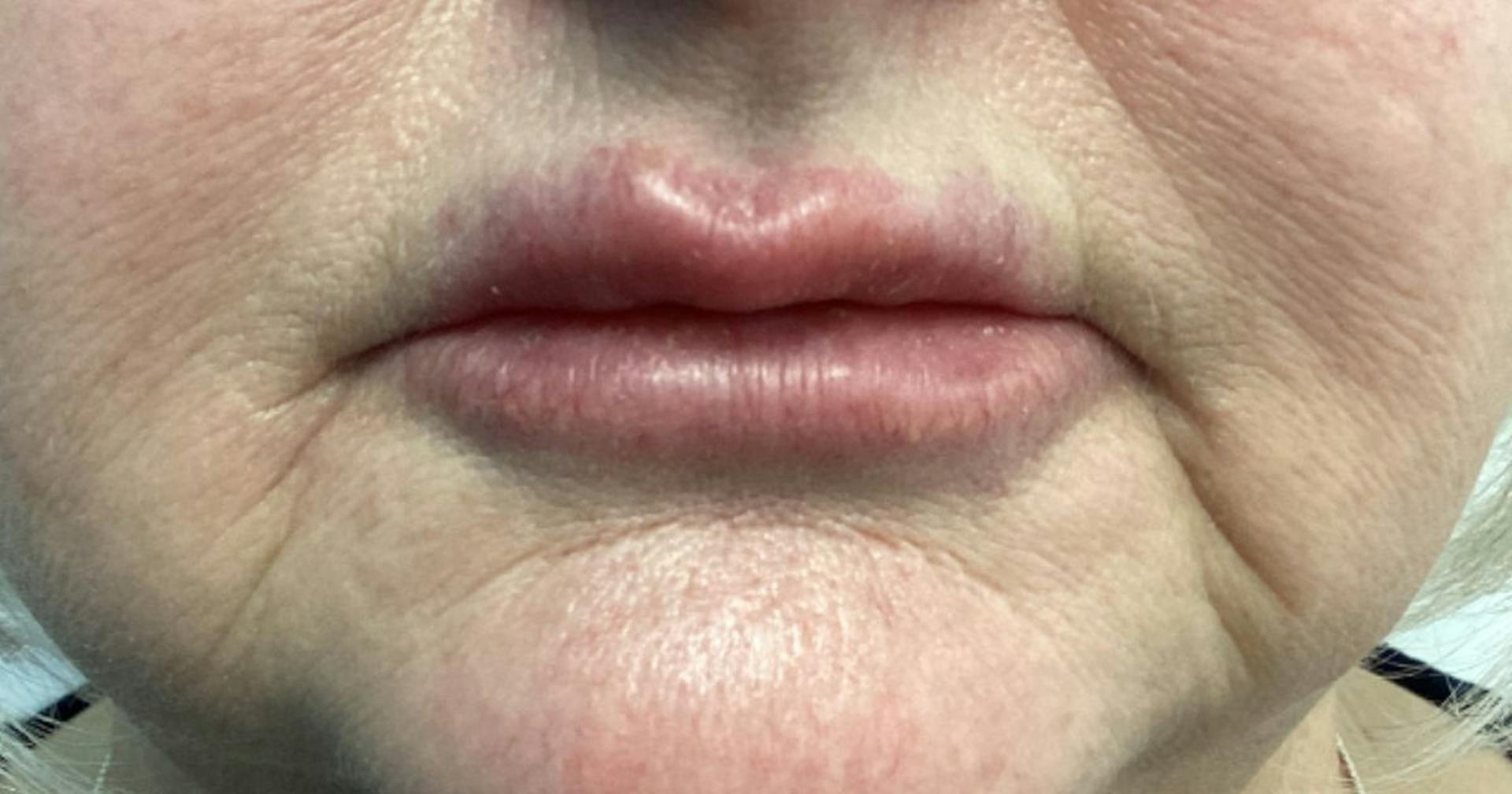 An Injectors' Guide to Filler-Related Nodules