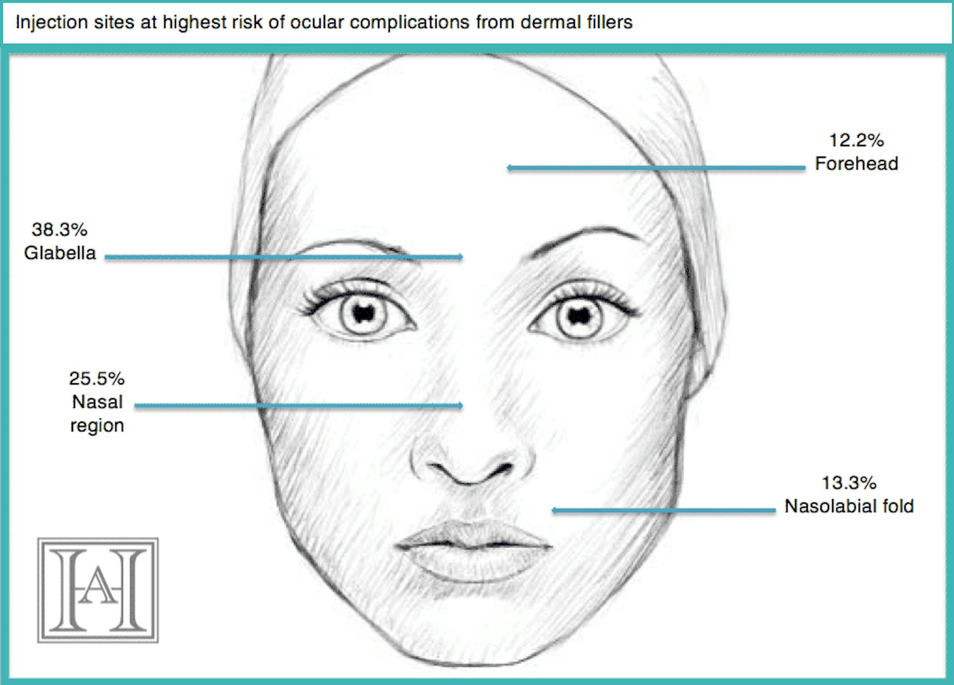 Blind To The Risk: 4 Ways To Avoid Blindness From Dermal Fillers