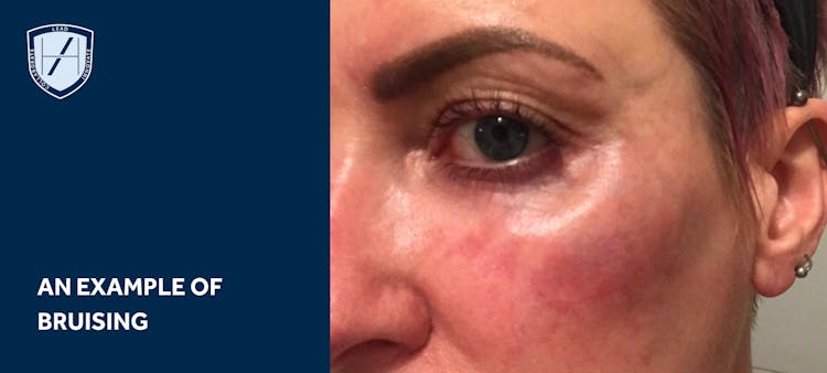 Exploring Non-Ischaemic Dermal Filler Complications | Harley Academy