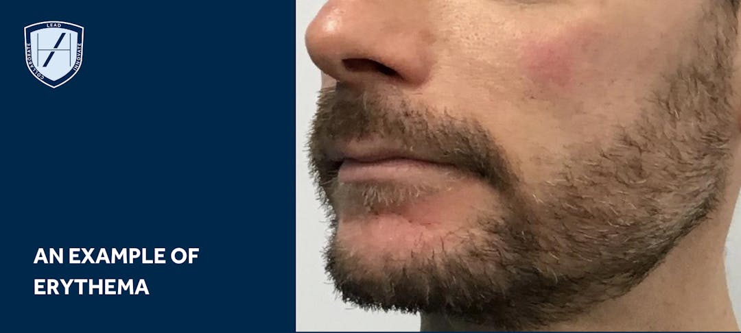 Exploring Non-Ischaemic Dermal Filler Complications | Harley Academy